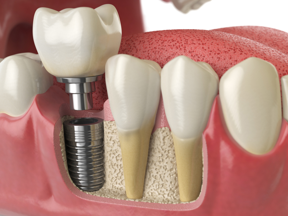 Implant Tedavisi - Dent32 Diş Kliniği - Beylikdüzü