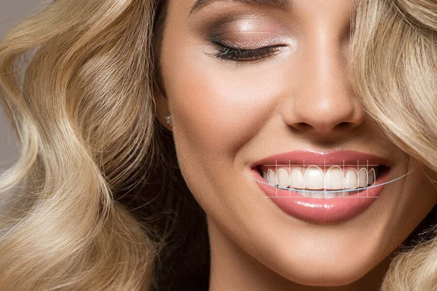 Hollywood Smile (Smile Design) - Dent32 Diş Kliniği - Beylikdüzü